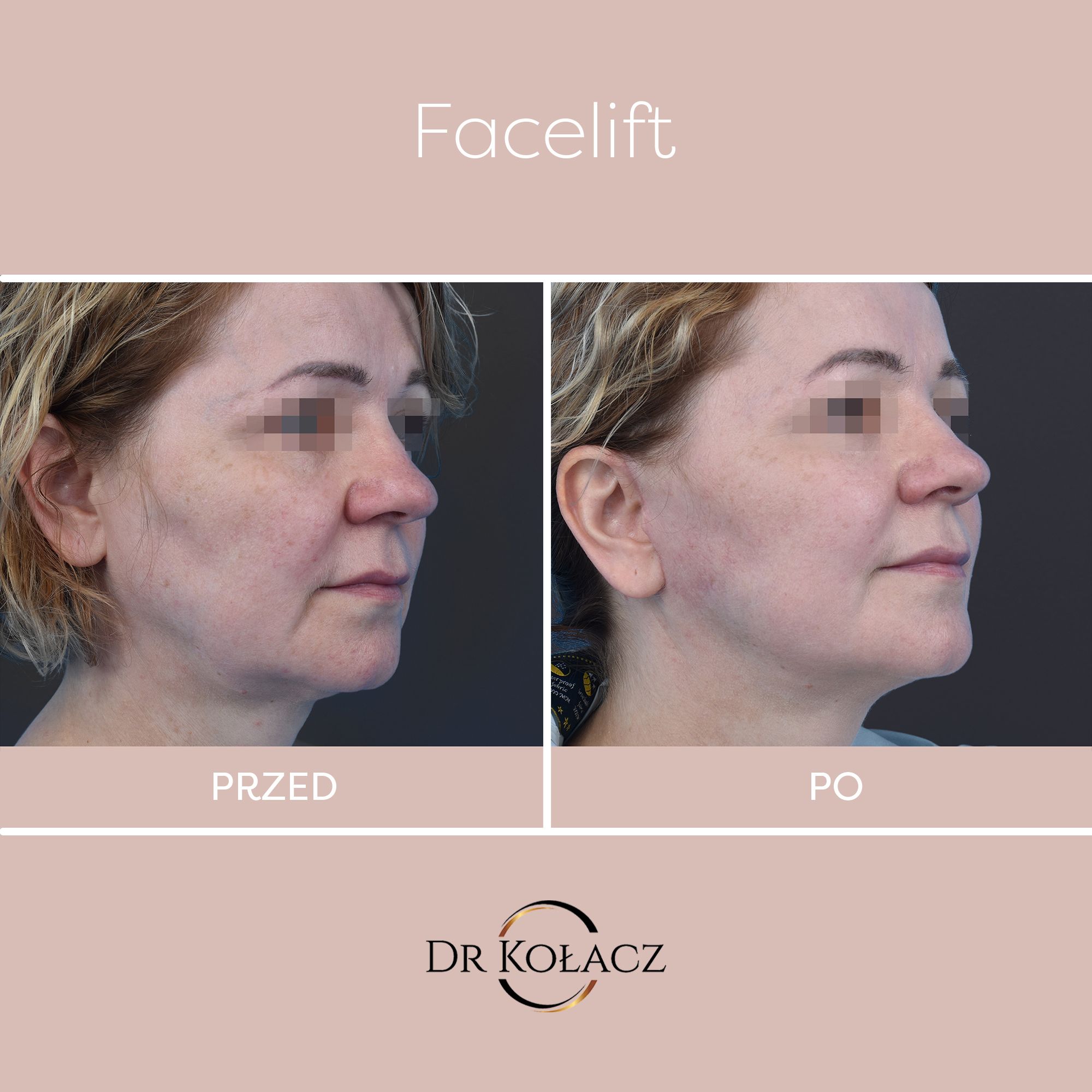 Lifting twarzy Przed i po - Estheticon.pl - Estheticon.pl