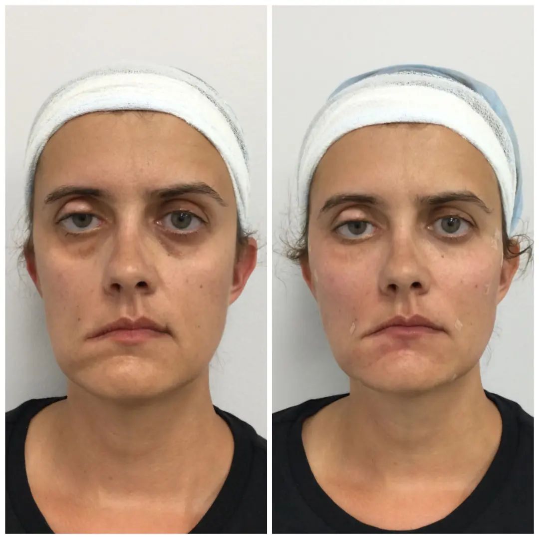 Lipofilling Przed i po - Estheticon.pl