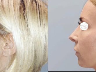 Bydgoszcz: Korekcja nosa (Operacja nosa) - Estheticon.pl