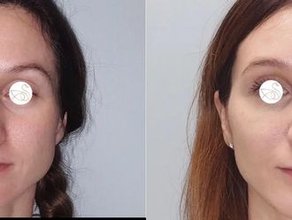 Korekcja nosa (Operacja nosa) Przed i po - Estheticon.pl