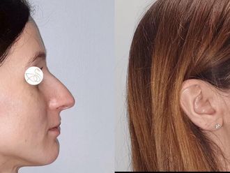 Korekcja nosa (Operacja nosa) Przed i po - Estheticon.pl